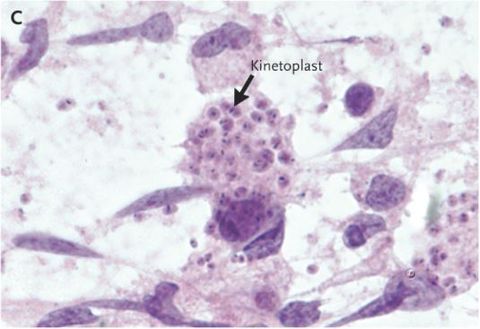 Man's Lurking Parasitic Infection 'Woke Up' In His Brain | Live Science