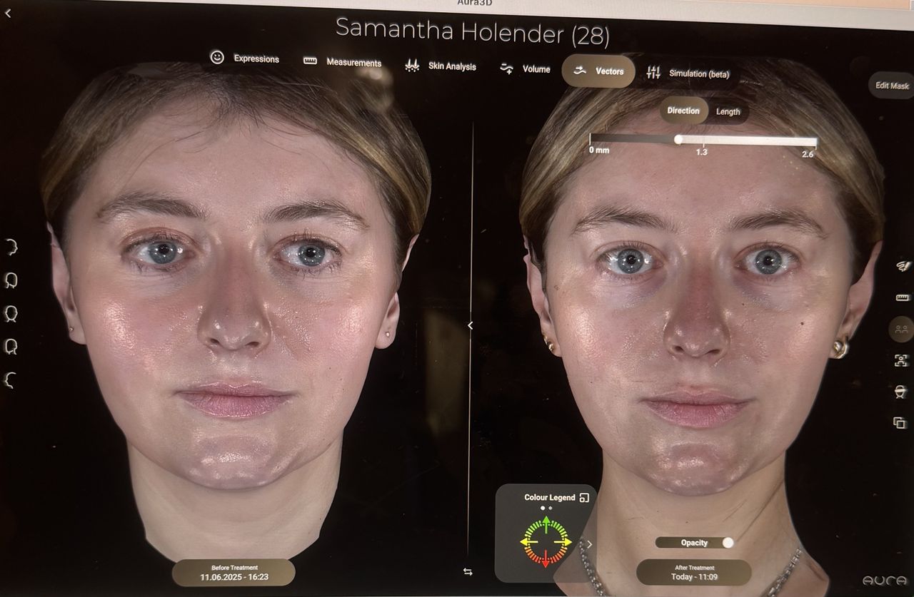 Sofwave Review: My Skin Tightening and Sculpting Results | Marie Claire