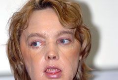 World's first full face transplant | Marie Claire UK