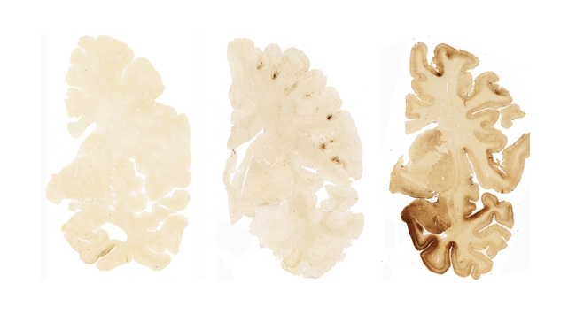 Images: Brains with CTE | Live Science