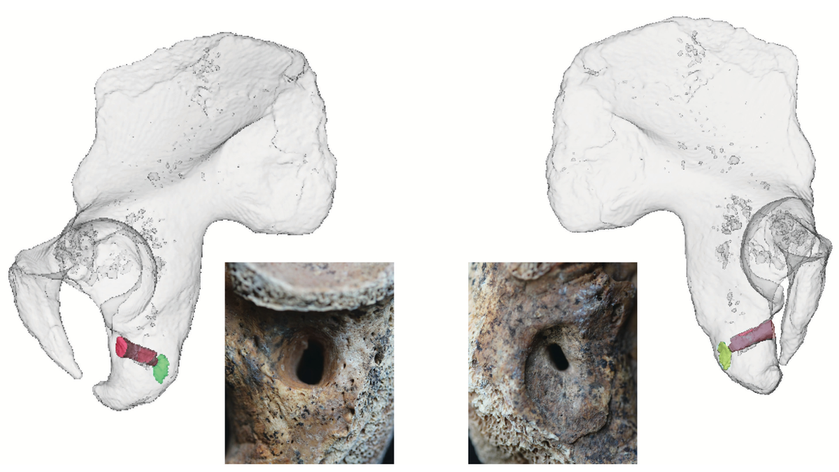 Elite Celtic warrior had healed arrowhead injury in his pelvis, 3D bone ...