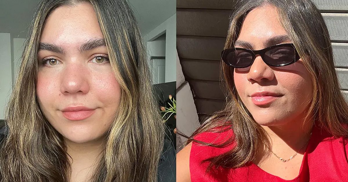 Lip Filler Dissolver: What It Is and What to Expect | Who What Wear