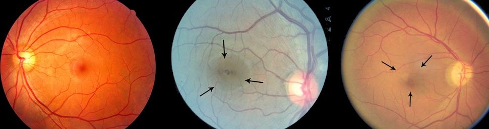 A Solar Eclipse Can Blind You (Read This Before Looking at the Sun ...