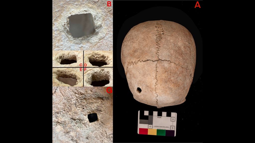 3rd-century-B.C. woman was buried facedown with a nail hole in her ...