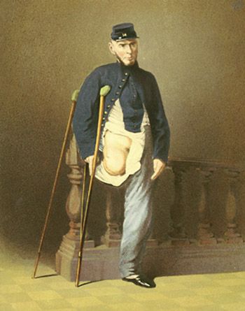 Album: Faces and Injuries of the Civil War | Live Science