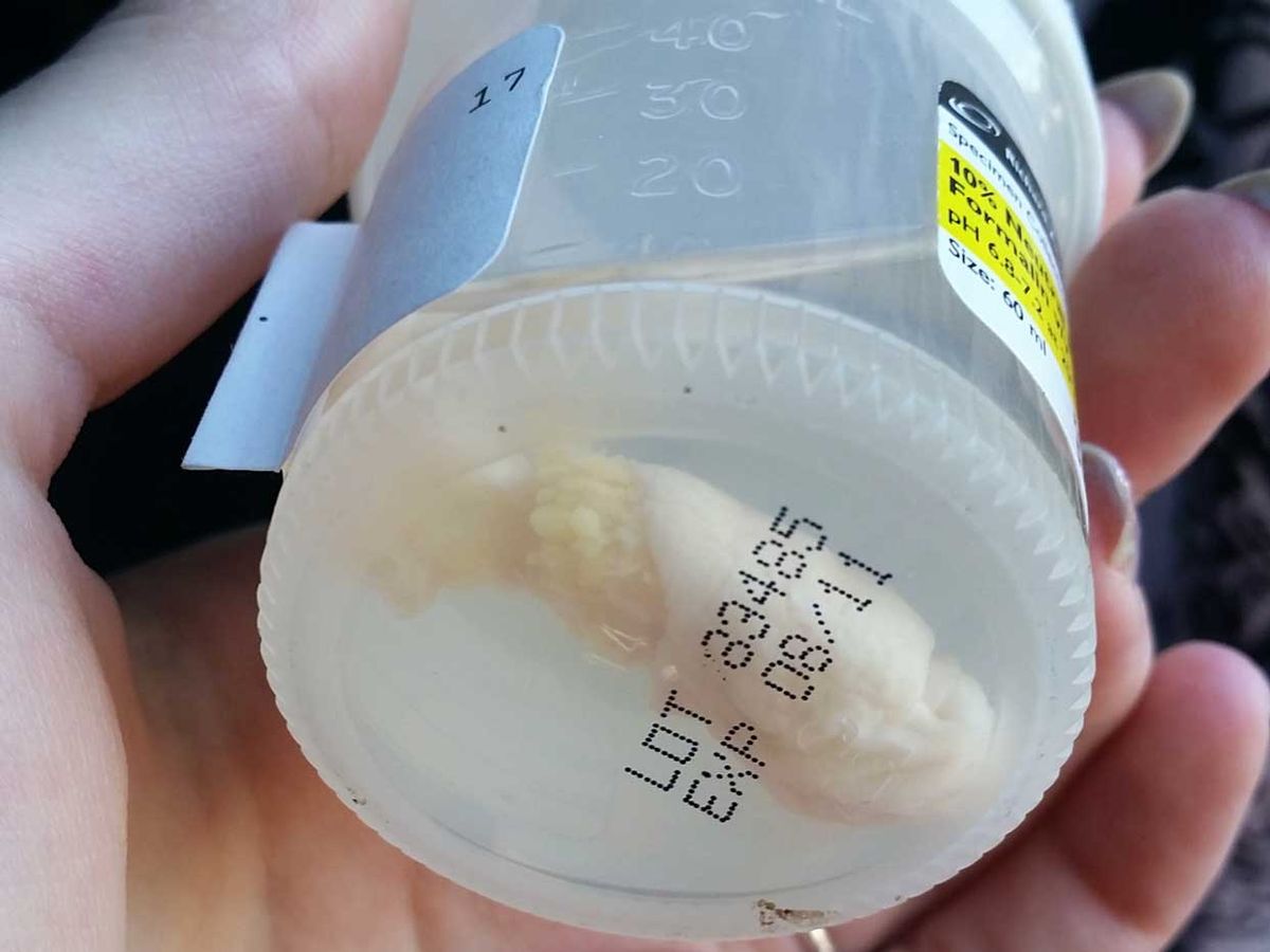 Tumblr user 'sends severed toe to make pendant' | The Week