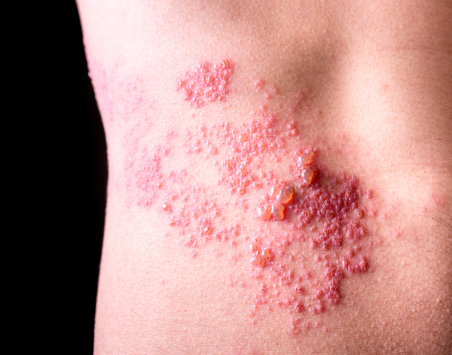 Shingles Causes Symptoms And Treatment Live Science Shingles Causes Symptoms And Treatment Live Science