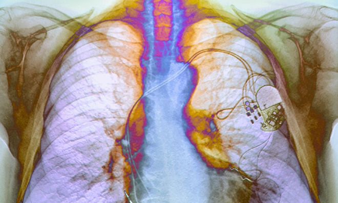 This biological pacemaker is all muscle | The Week