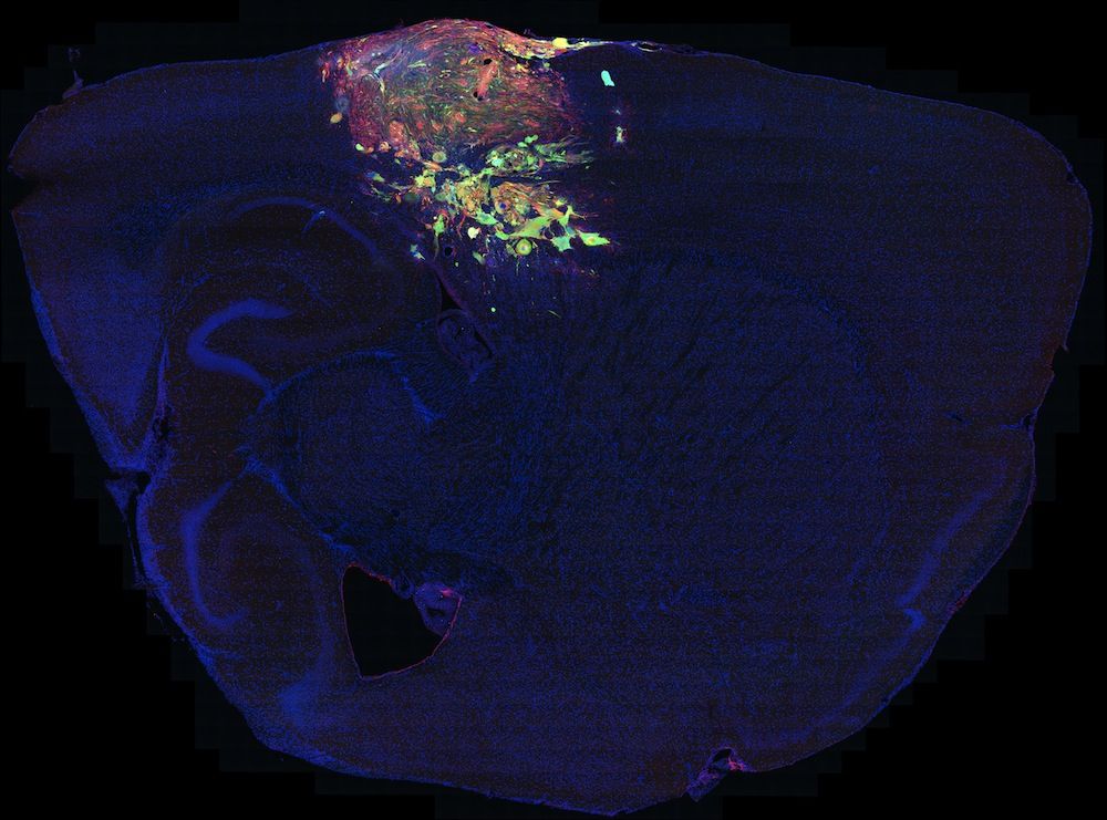 Colorful But Deadly: Images of Brain Cancer | Live Science
