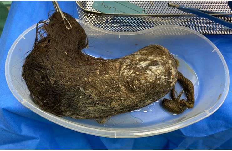 Giant hair ball tears through teen's stomach, requiring surgery | Live ...