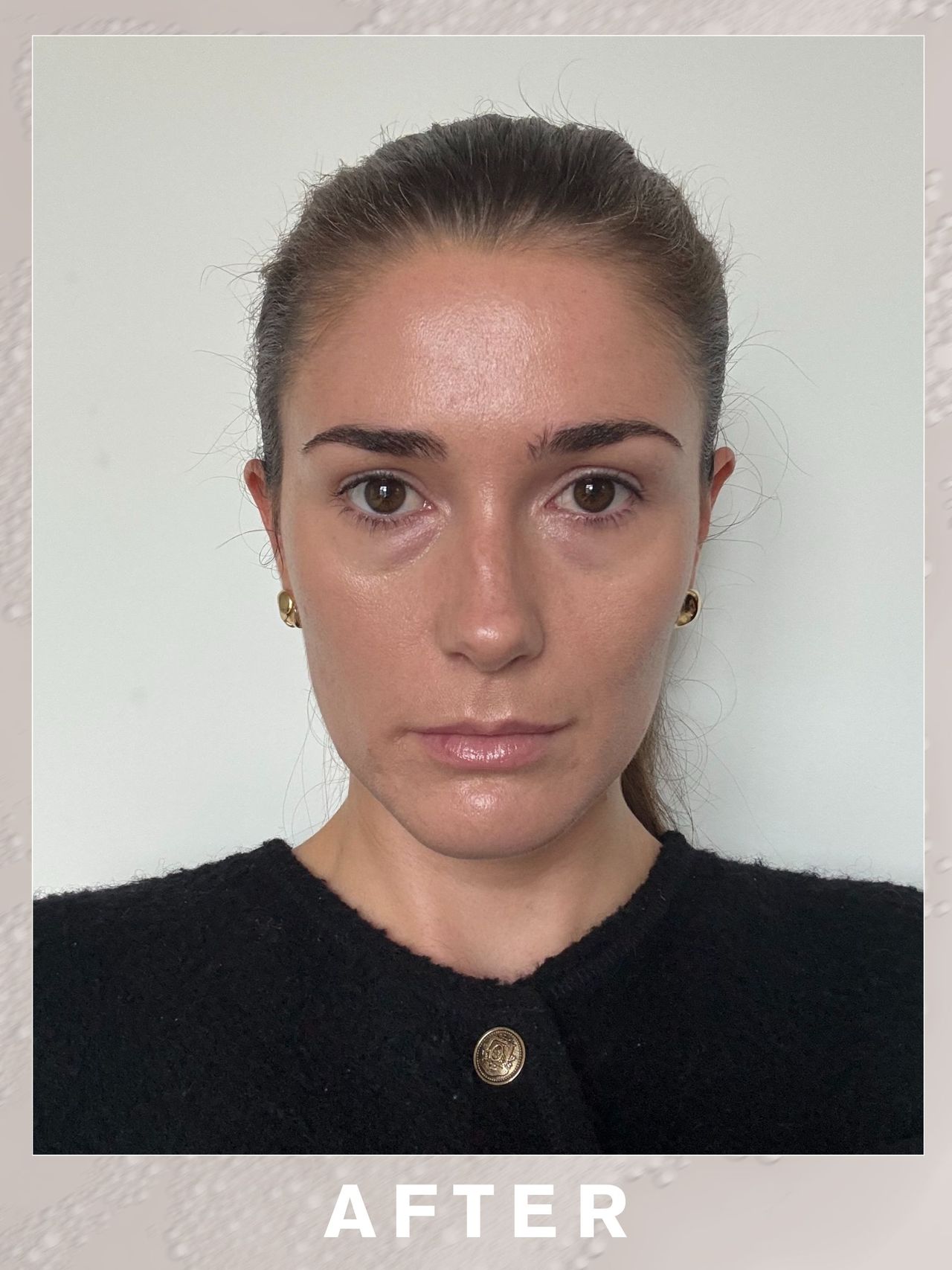 Sofwave Brow Lift Reviewed by a Beauty Editor | Who What Wear