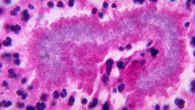 This rare bacterial infection triggers pus-filled sores in the lungs ...