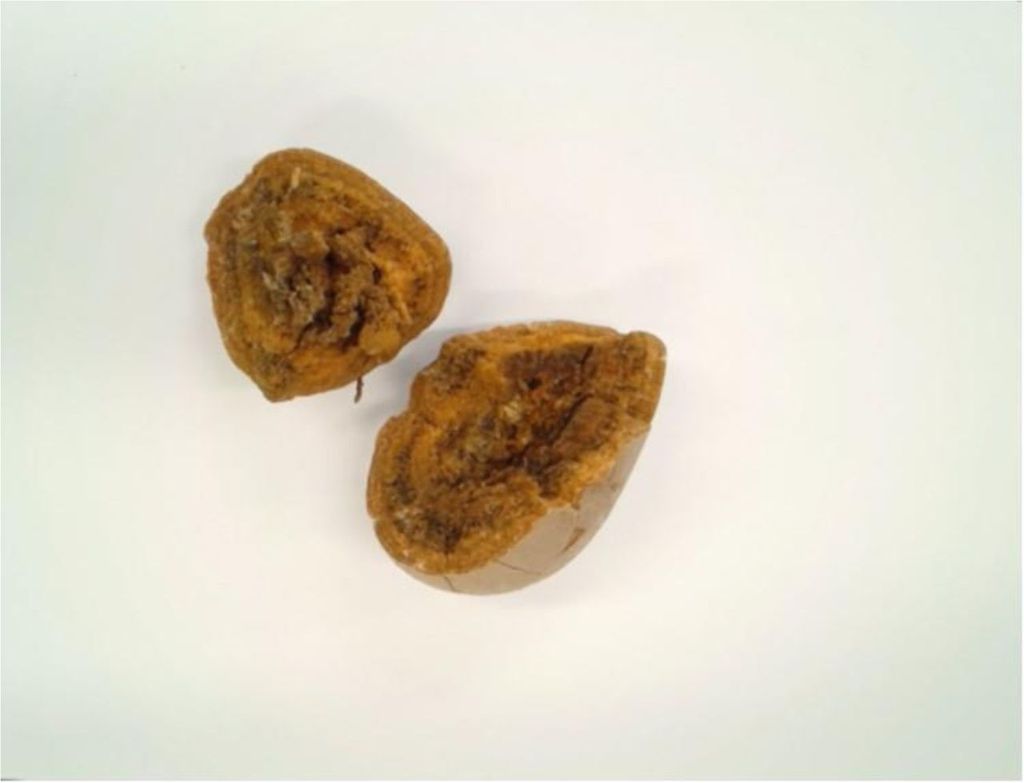 How surgery in infancy led to a woman's stone 60 years later | Live Science