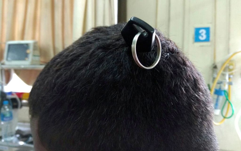 This Man Had a Key Lodged in His Brain. Here's How He Survived. | Live ...