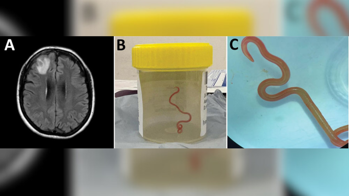 Australia woman's brain invaded by parasitic worm that normally infects ...