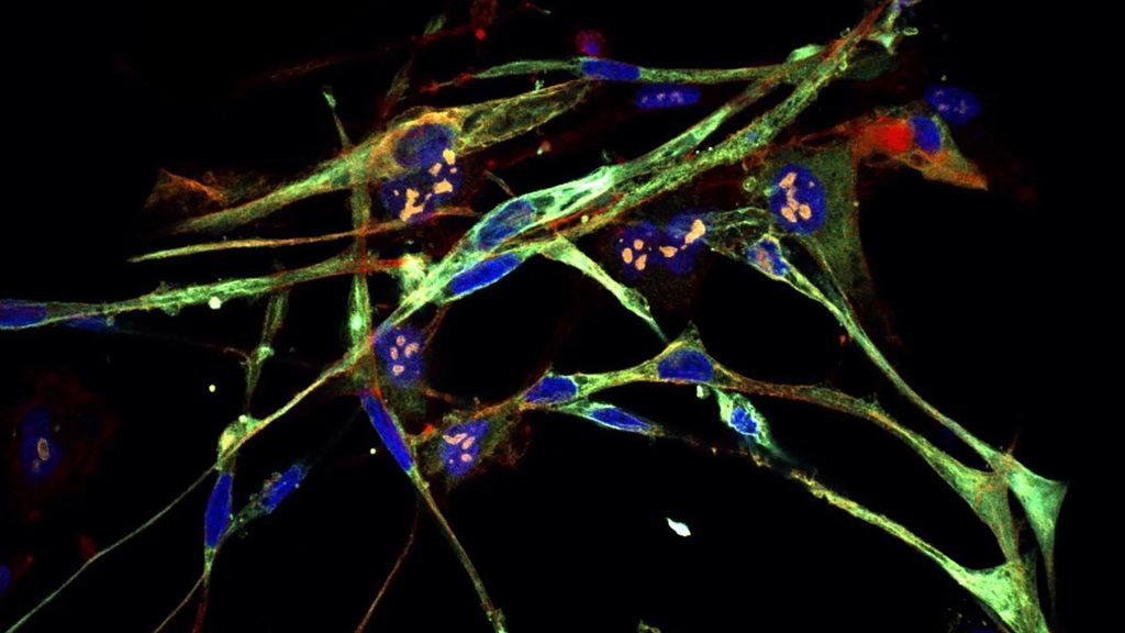 CRISPR used to 'reprogram' cancer cells into healthy muscle in the lab ...