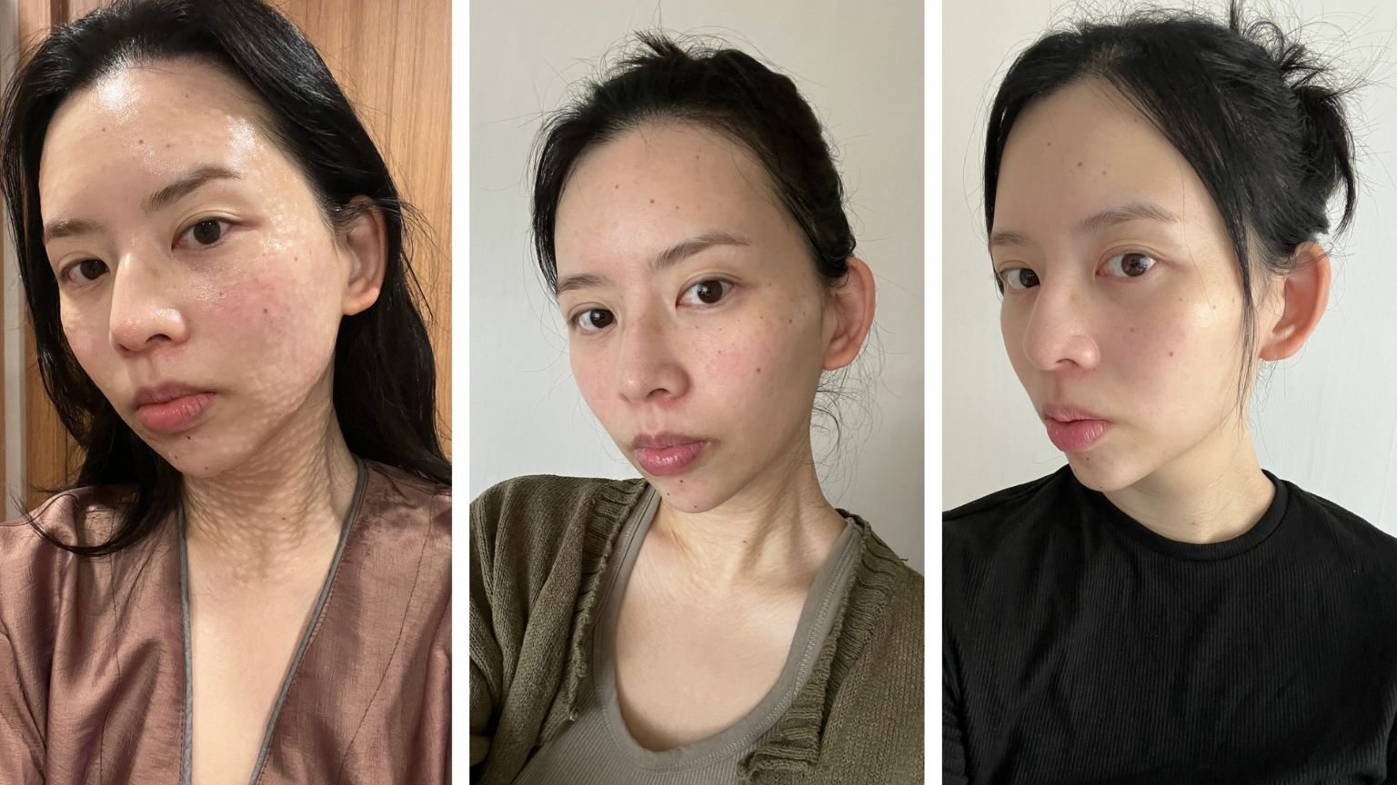 Review: Salmon Sperm Injections for Skin, Per a Beauty Writer In Korea ...