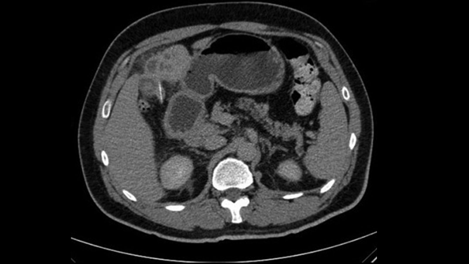 Diagnostic dilemma: A fish bone wandered through a man's abdomen and ...