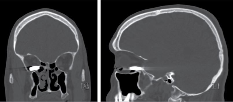 Don't Blink: Striking Image Shows Bullet in Man's Eye Socket | Live Science