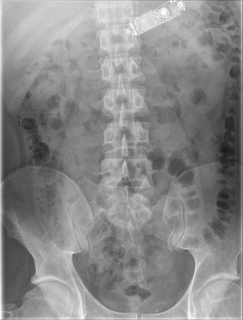 11 Weird Things People Have Swallowed | Live Science