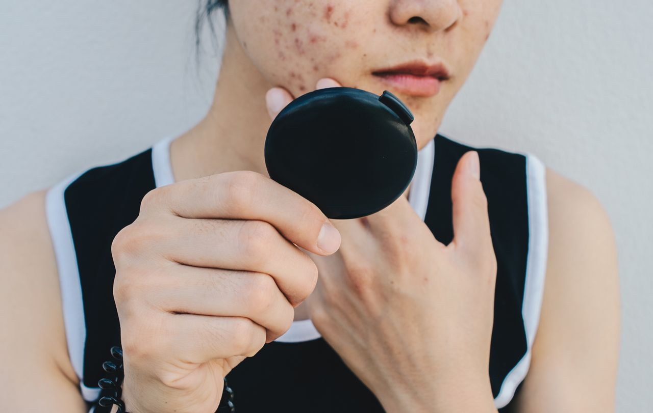 Can Dry Skin Cause Acne We Ask A Dermatologist To Explain My