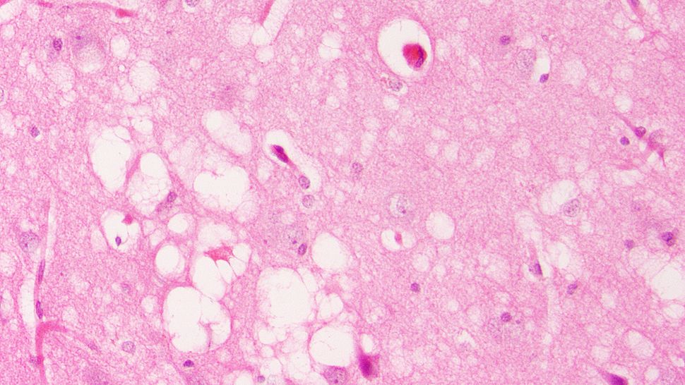 Do any infectious diseases have a 100% fatality rate? | Live Science