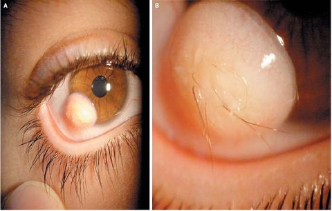 'Hairy Eyeball' Caused by Rare Tumor | Live Science