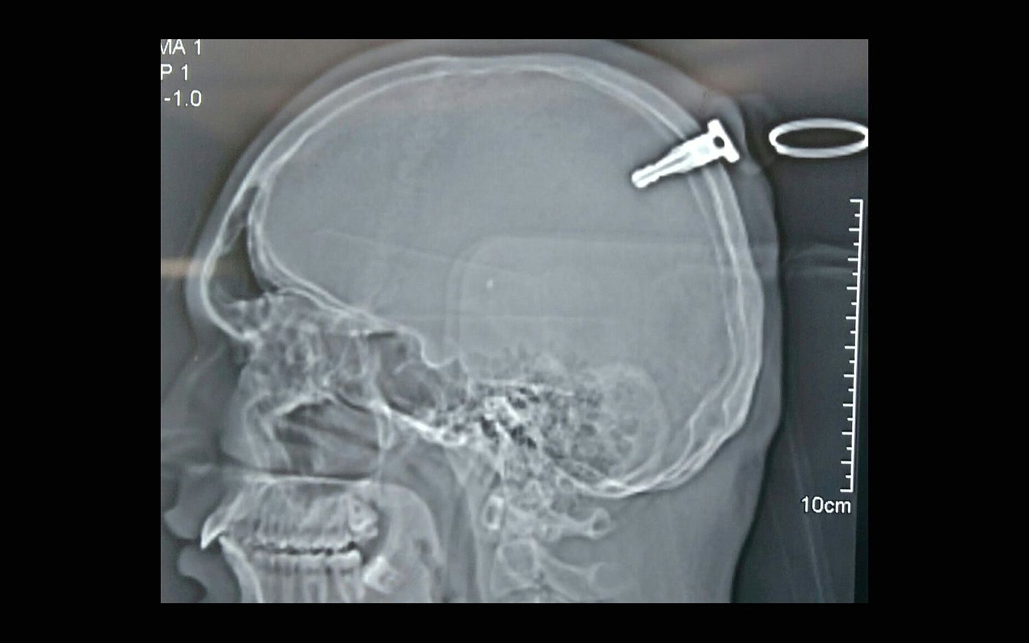 This Man Had a Key Lodged in His Brain. Here's How He Survived. | Live ...