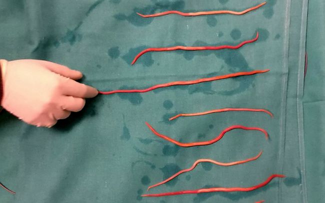 Doctors Pulled 14 Squirming Roundworms from a Woman's Bile Ducts | Live ...