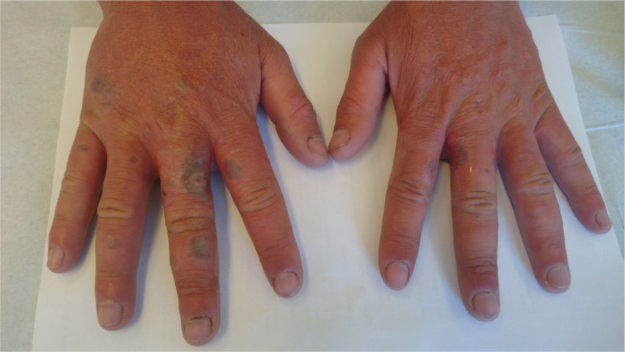 How the Midnight Sun Gave This Man 'Rotten Zombie Skin' | Live Science