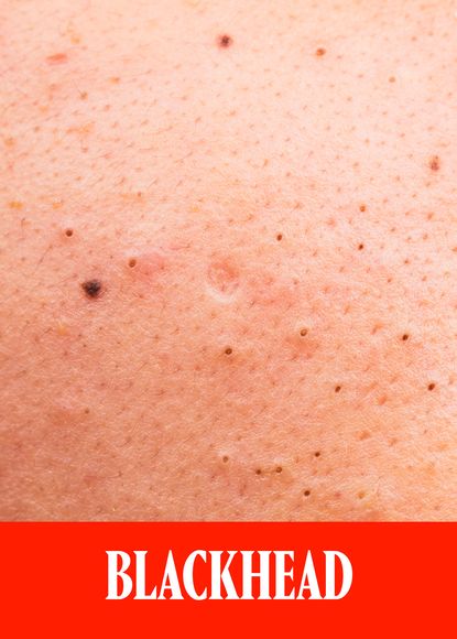 The 4 Types of Acne and How to Treat Each (With Pictures) | Marie Claire