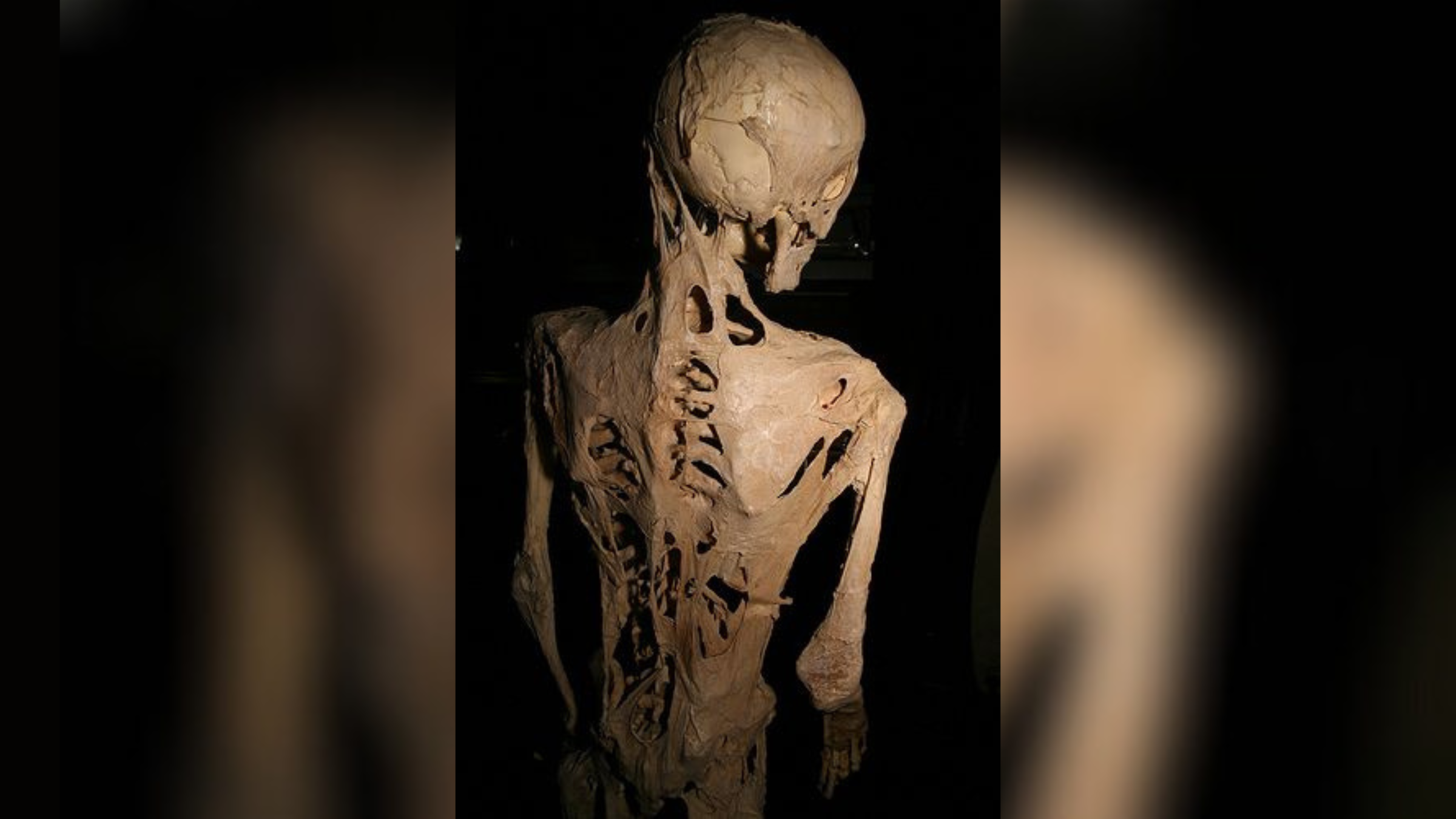 Stone man disease: A rare condition that causes a person to grow a ...