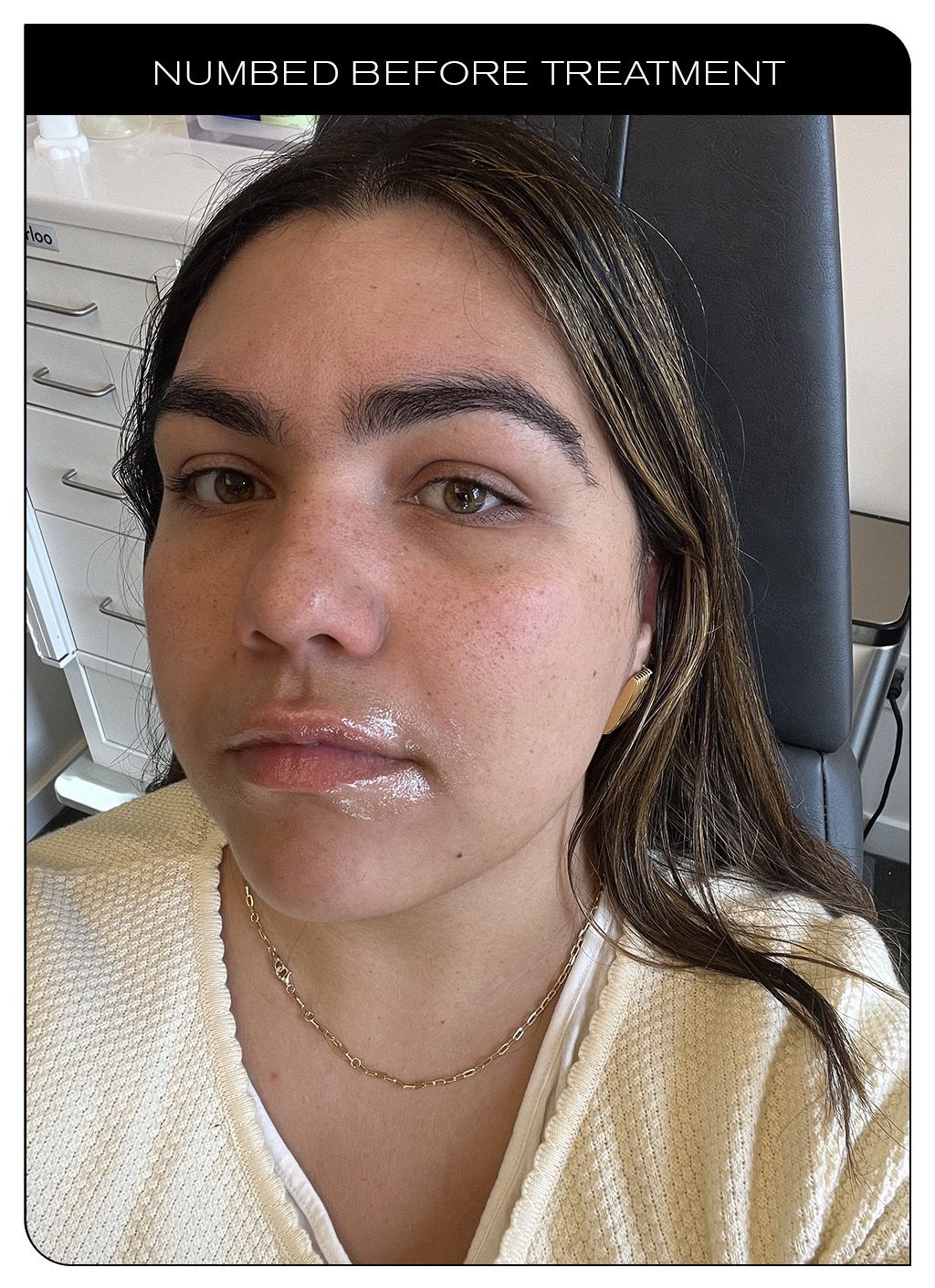 Lip Filler Dissolver: What It Is and What to Expect | Who What Wear