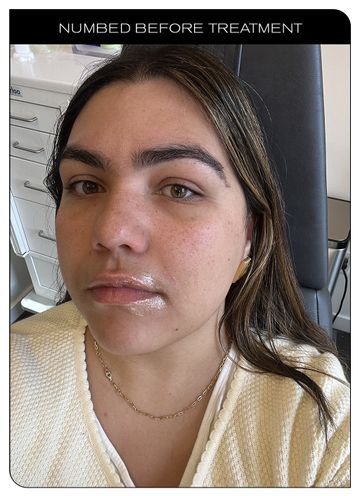 Lip Filler Dissolver: What It Is and What to Expect | Who What Wear