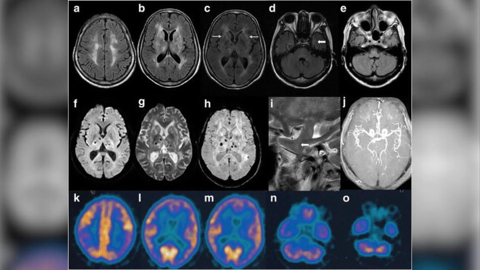 Fatal Familial Insomnia A Genetic Condition Where People Never Sleep Again Live Science