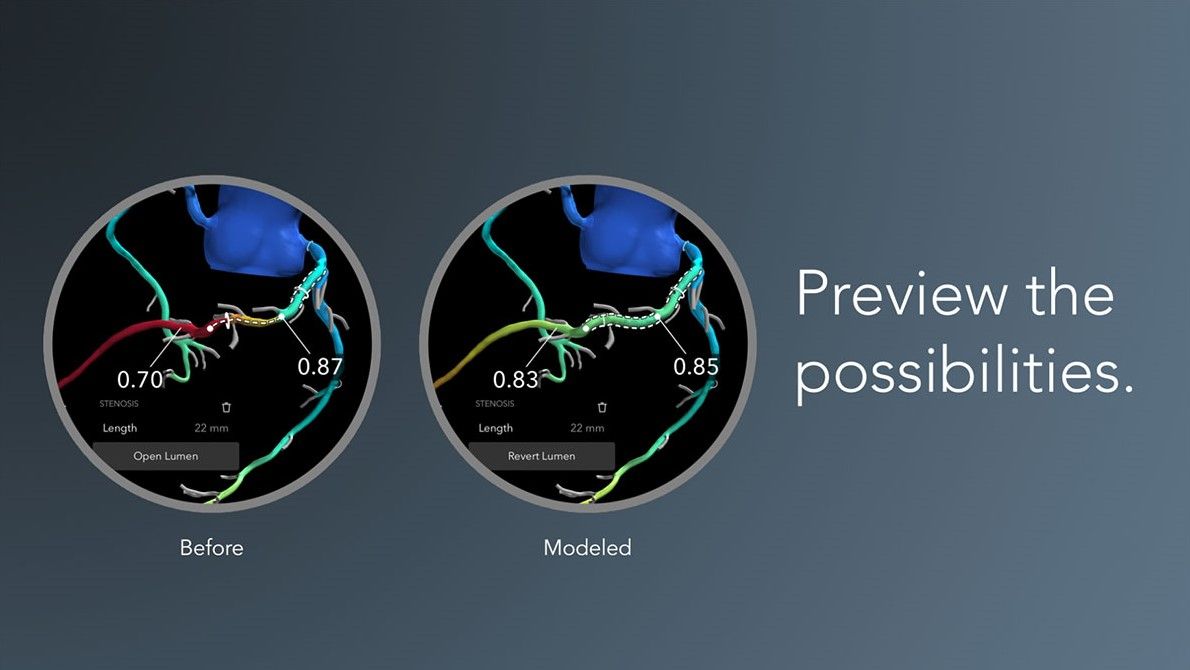 Virtually modelling surgery in real-time: a Q&A with HeartFlow | TechRadar