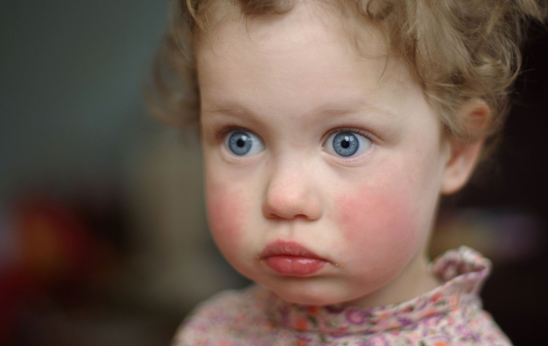 Slapped cheek syndrome: this childhood condition causes red cheeks | GoodTo