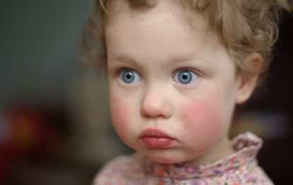 Slapped cheek syndrome: this childhood condition causes red cheeks | GoodTo