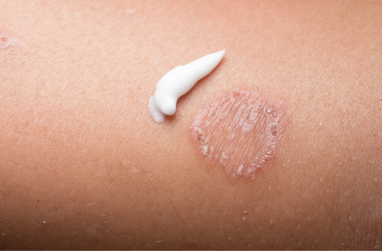 Ringworm: What is ringworm and how do you get it? | GoodTo
