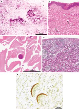 Man's body crawling with parasitic worms after infected kidney ...