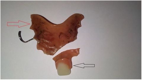 Hard to Swallow: Man's Missing Dentures Found in His Esophagus | Live ...
