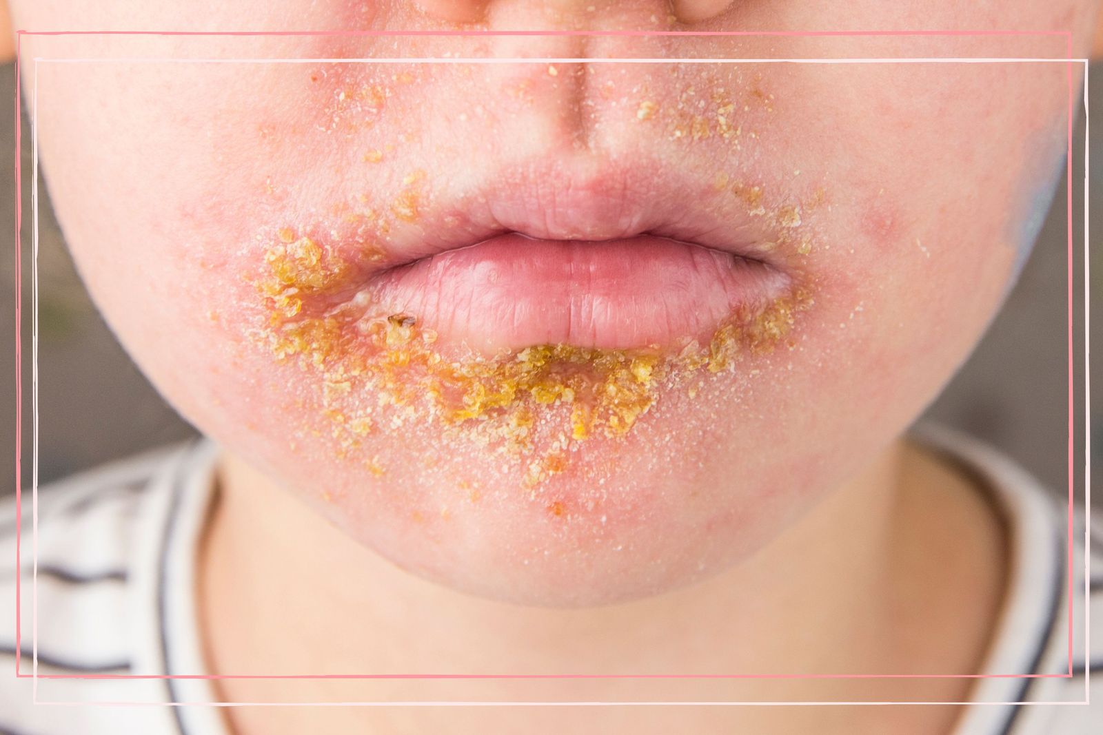 Advice on impetigo from doctors, for parents | GoodtoKnow
