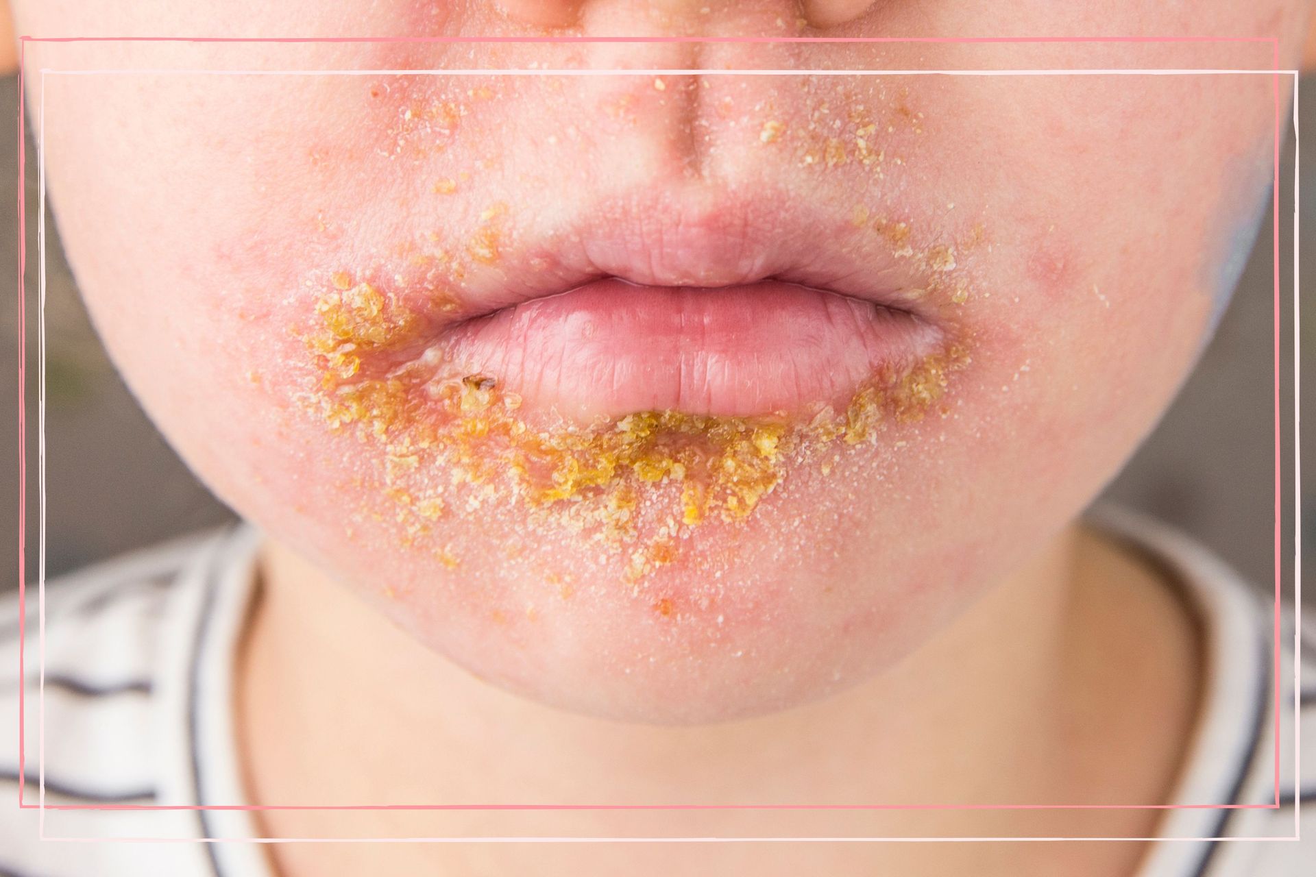 Advice on impetigo from doctors, for parents | GoodtoKnow