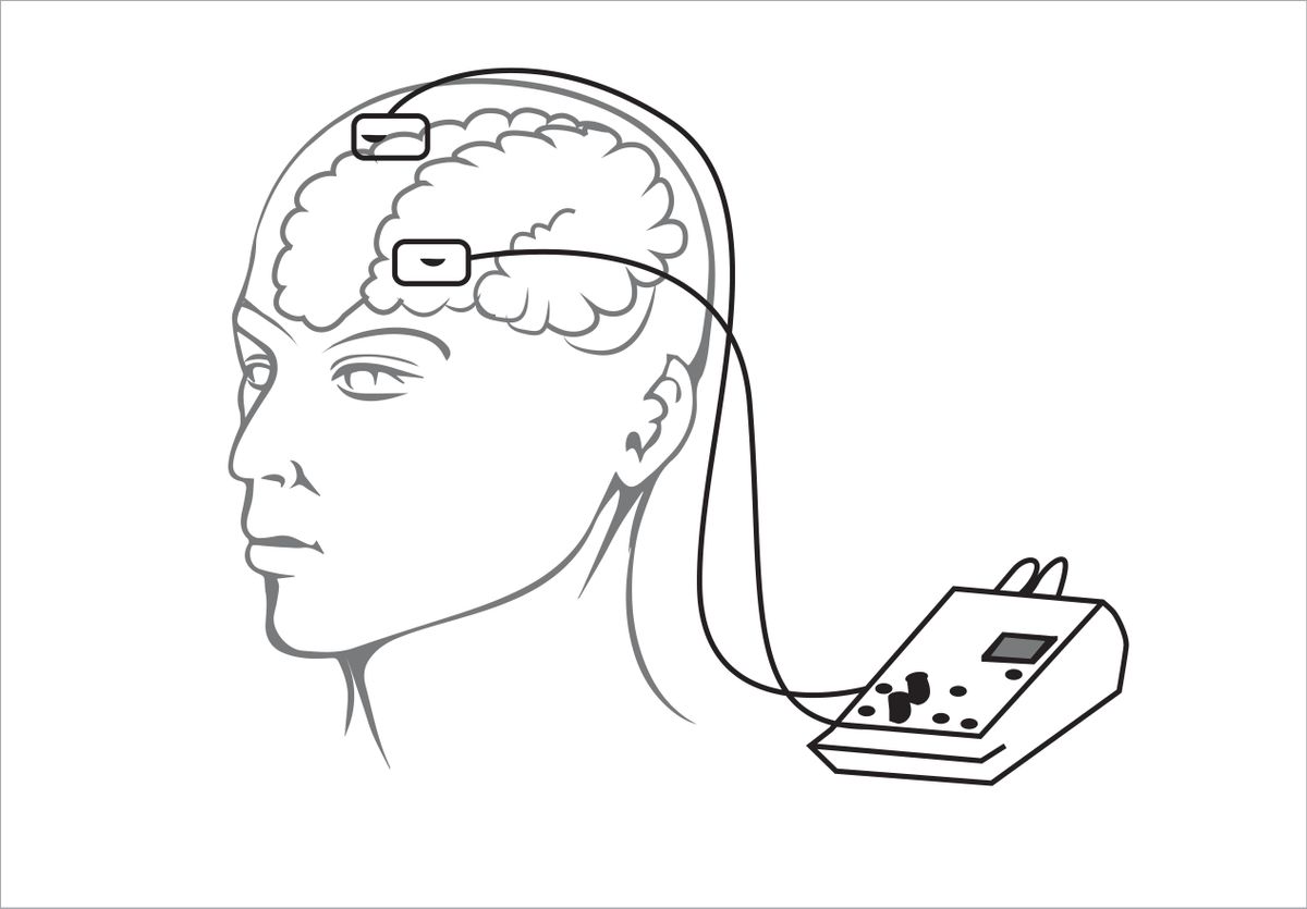 Why'd I Come in Here? A Brain Zap Could Boost That Fuzzy Memory | Live ...