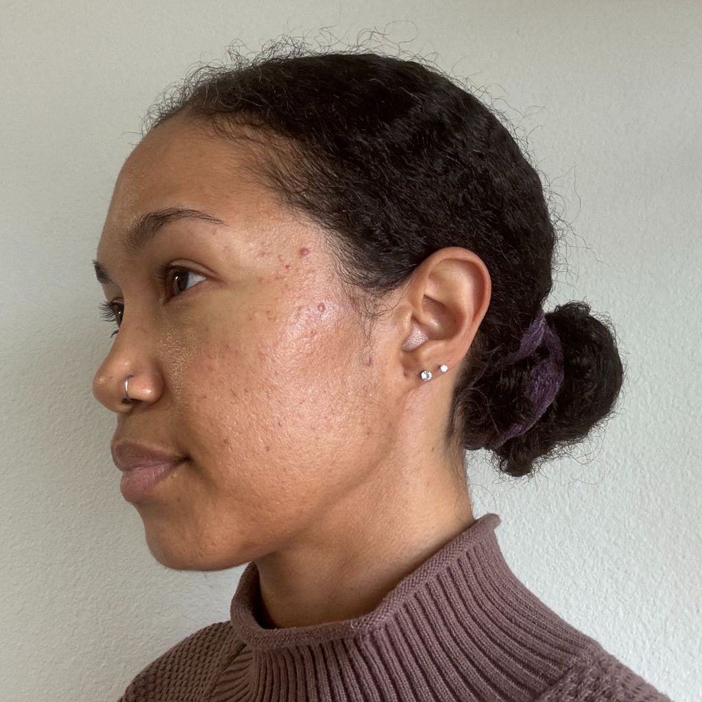 A Beauty Editor Reviews Cellstory Liquid Micro-Needling | Who What Wear