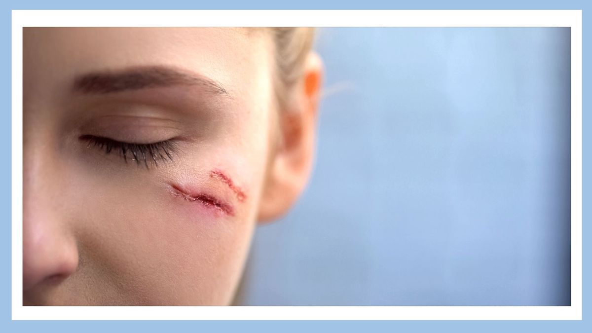 What's going on with Scar Girl, TikTok's latest drama? | My Imperfect Life