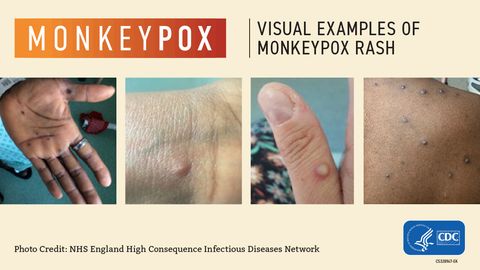 Mpox (monkeypox): Symptoms, pictures, treatments & vaccines | Live Science