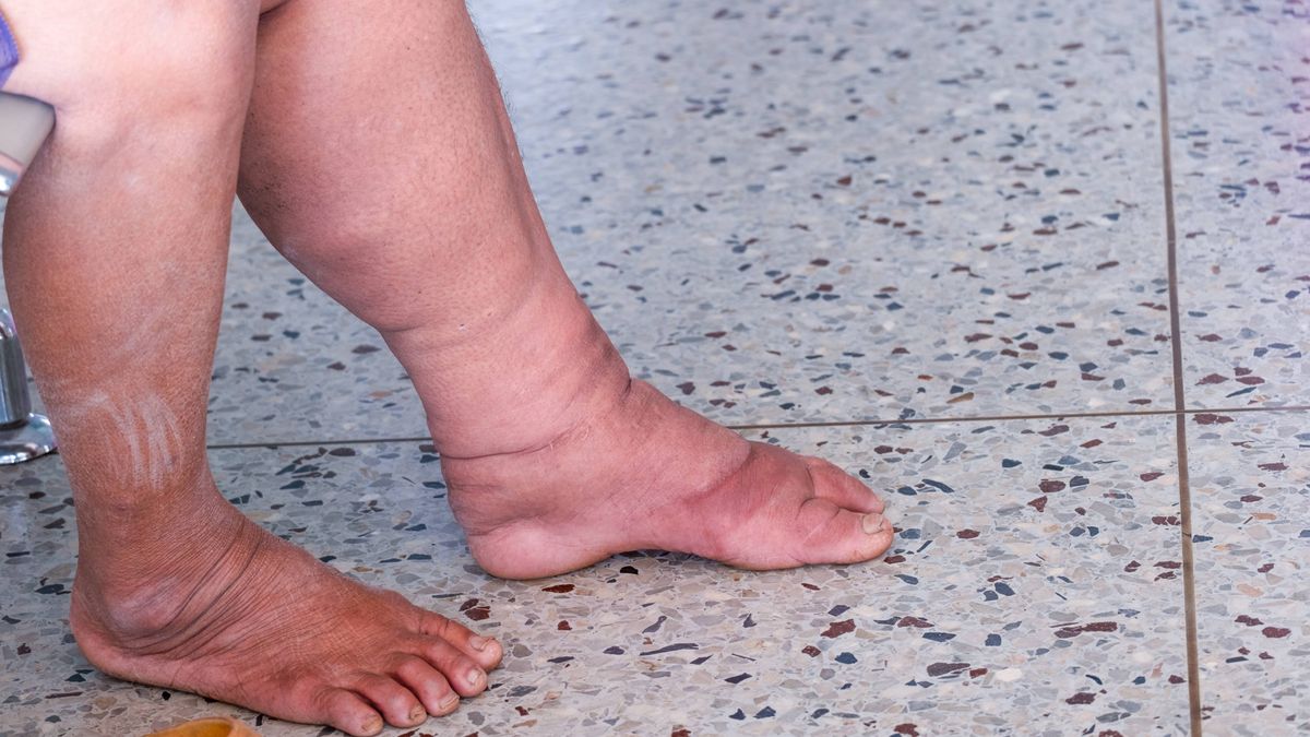 32 scary parasitic diseases | Live Science