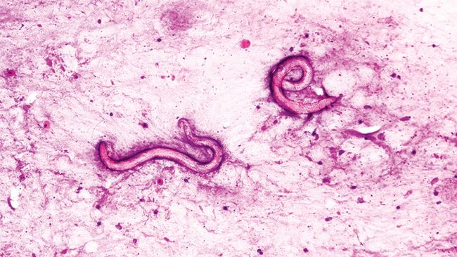 Man's body crawling with parasitic worms after infected kidney ...