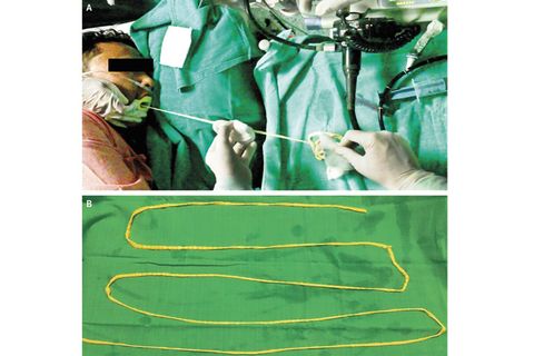 8 awful parasite infections that will make your skin crawl | Live Science